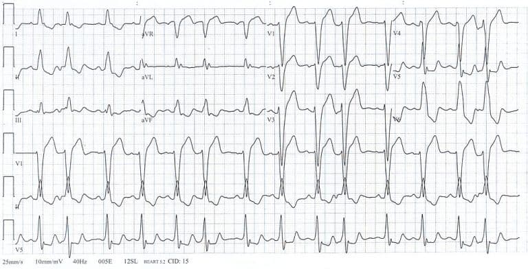 ECG Abnormalities - almostadoctor
