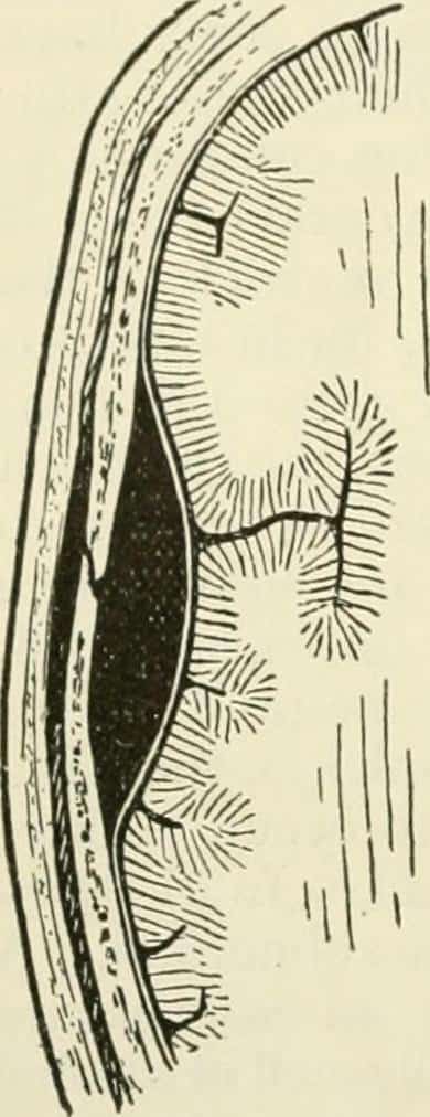 Extradural Haemorrhage - almostadoctor