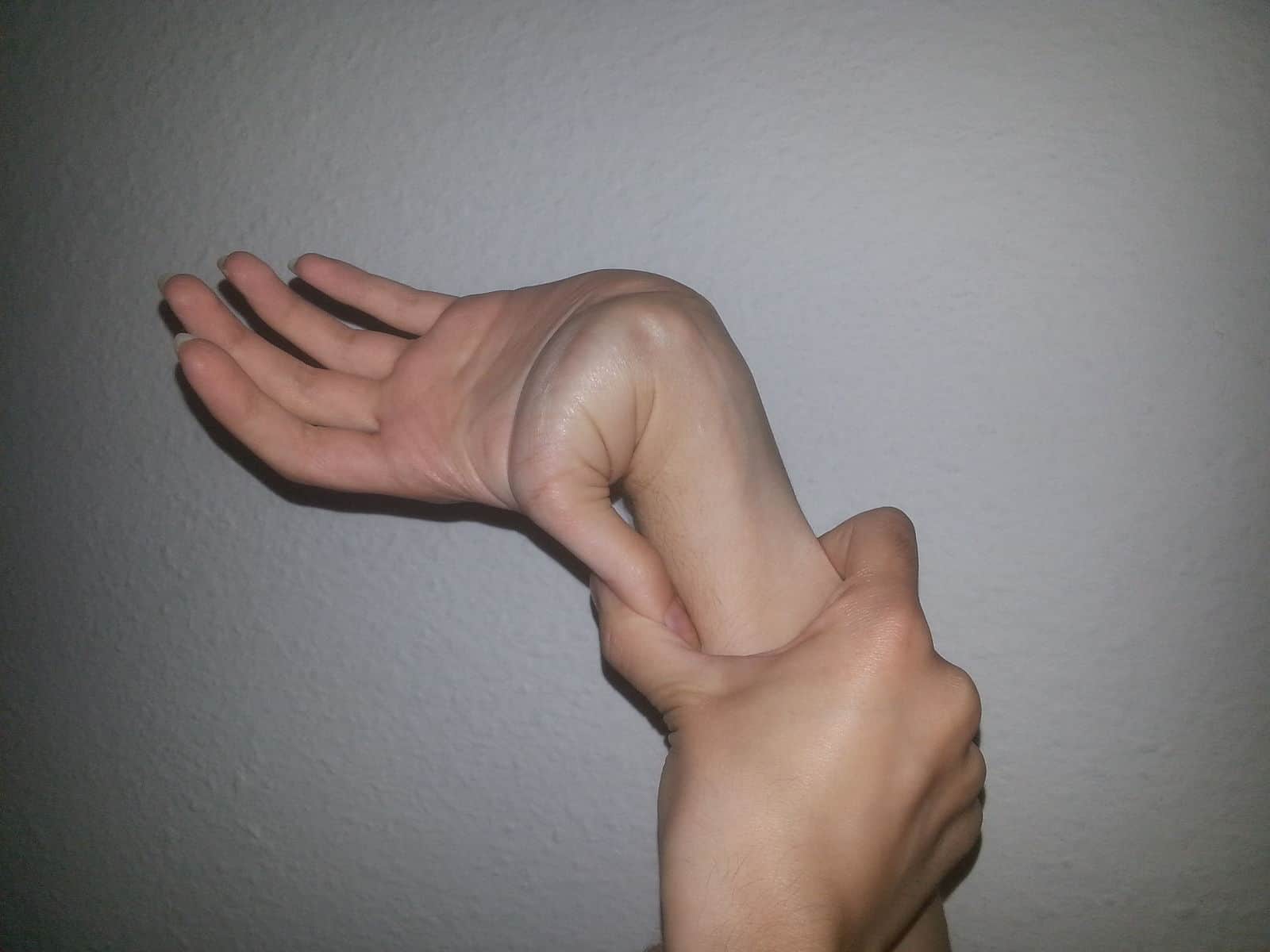 Marfan Syndrome Almostadoctor