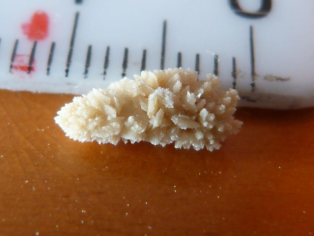 Kidney Stone (Renal Calculus) - almostadoctor