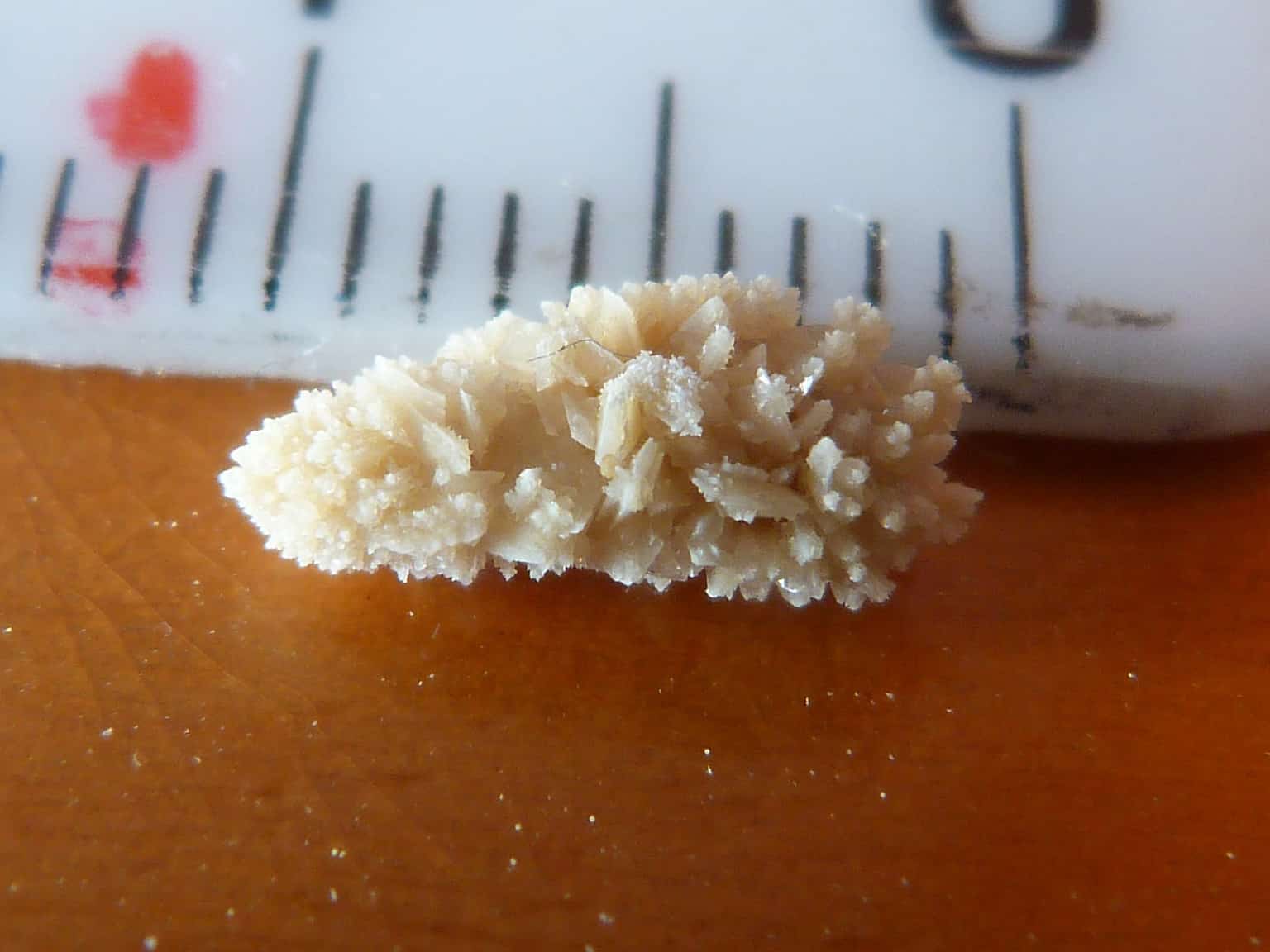 Kidney Stone (Renal Calculus) - almostadoctor
