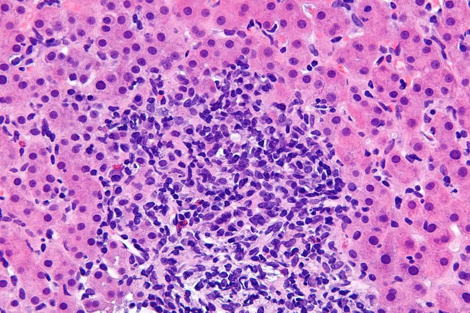 Autoimmune Hepatitis - almostadoctor