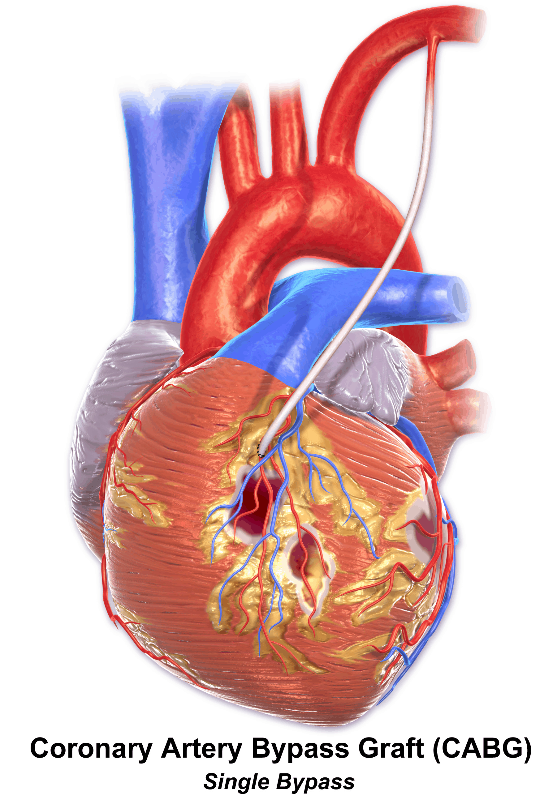 Coronary Artery Bypass Grafting CABG Medical Stock 60 OFF Coronary Artery Bypass Grafting CABG Medical Stock 60 OFF