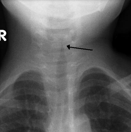 Croup and other laryngeal and tracheal infections - almostadoctor