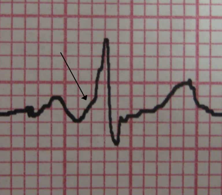 Wolff-Parkinson-White Syndrome - almostadoctor