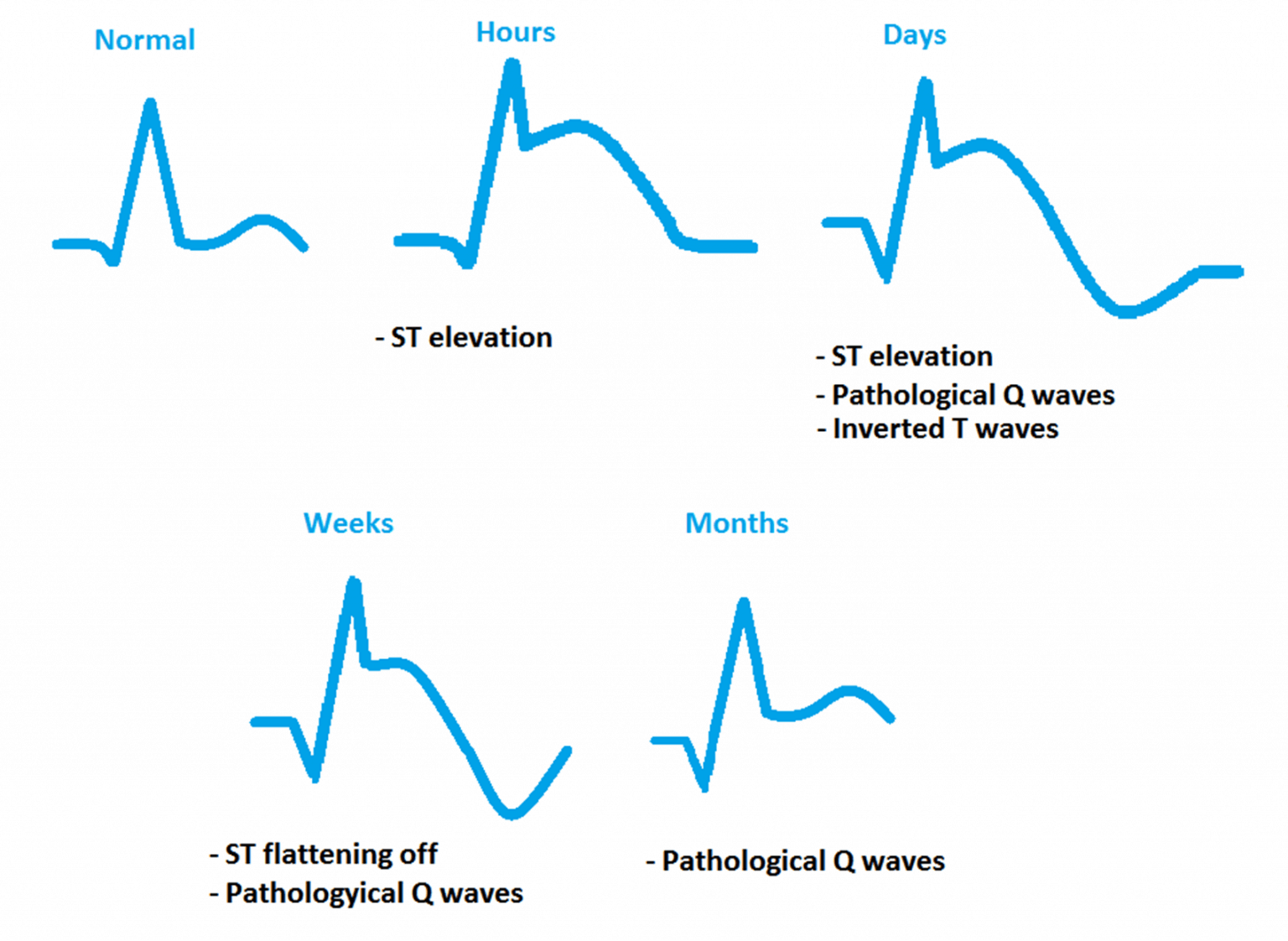 Myocardial Infarction and Acute Coronary Syndromes (ACS) - almostadoctor