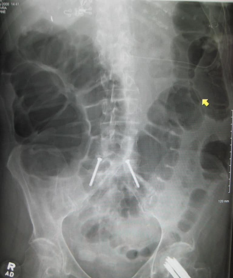 Large Bowel Obstruction - almostadoctor