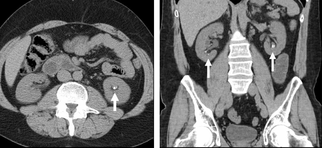 Kidney Stone (Renal Calculus) - almostadoctor