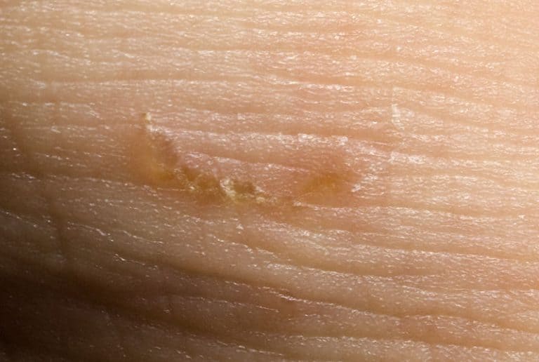 Scabies - almostadoctor