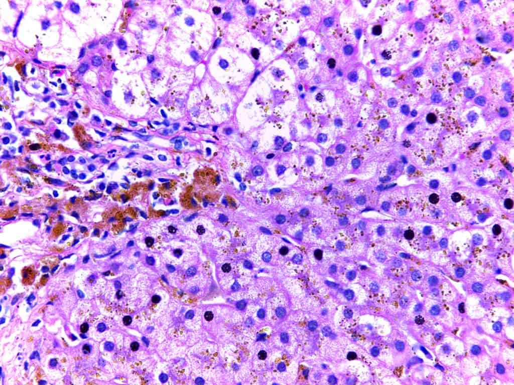 Haemochromatosis - almostadoctor