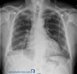 Chest X-Ray - almostadoctor