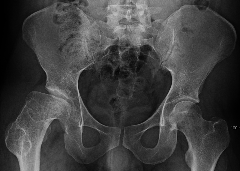 Perthes Disease Almostadoctor