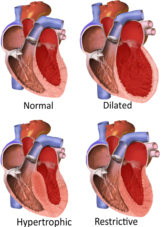 Cardiomyopathy Almostadoctor Cardiomyopathy Almostadoctor