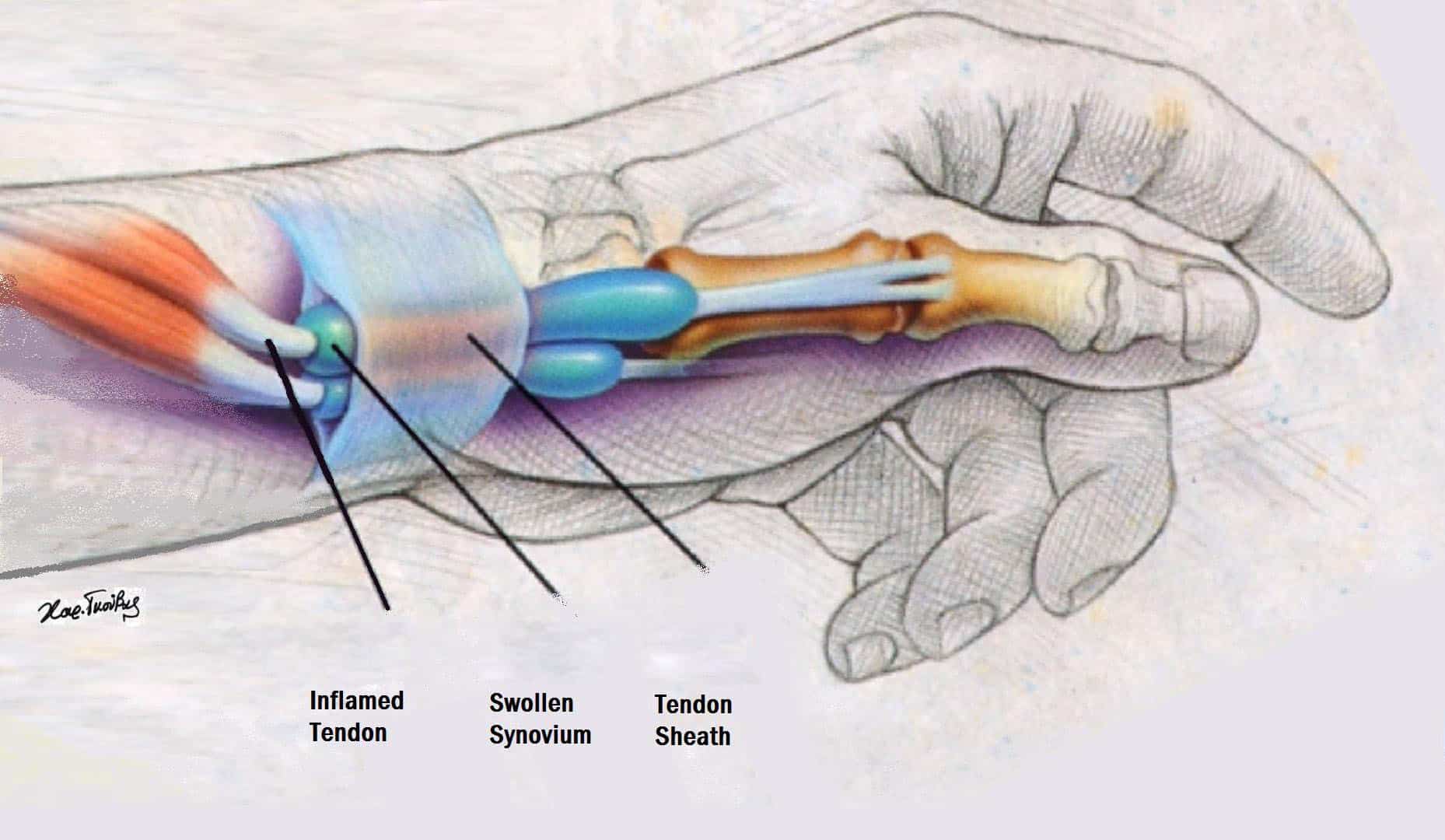 De Quervain Tenosynovitis Almostadoctor