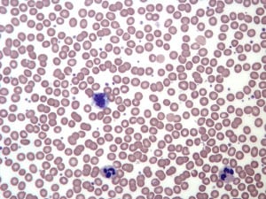 Microcytic anaemias - almostadoctor