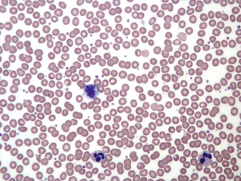 Microcytic anaemias - almostadoctor