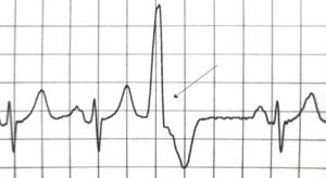 Premature Ventricular Complexes (PVCs) - almostadoctor