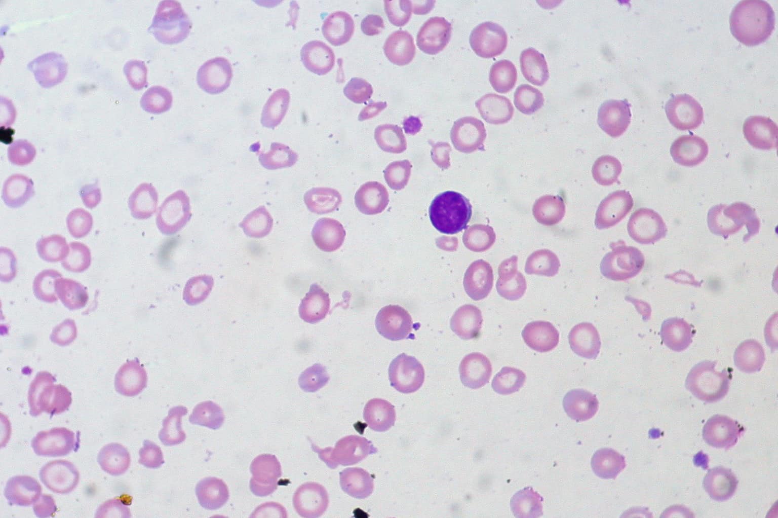 Microcytic anaemias - almostadoctor