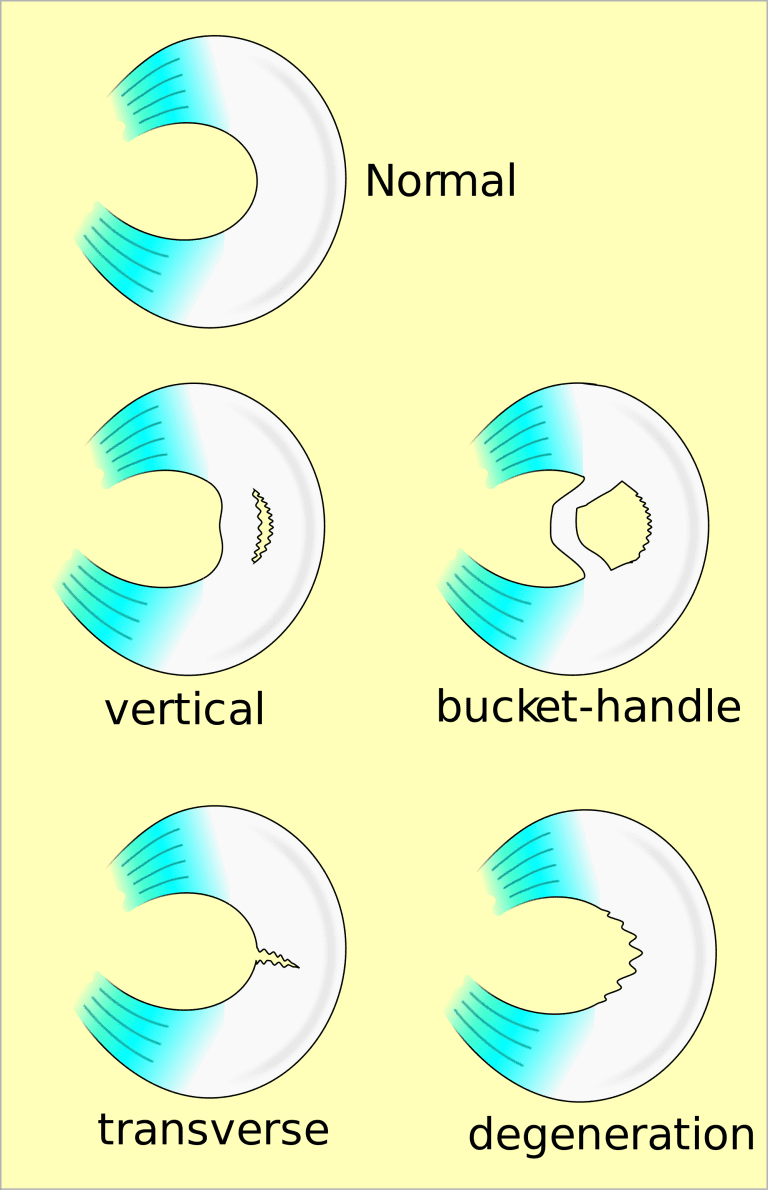 Meniscal Injuries - almostadoctor